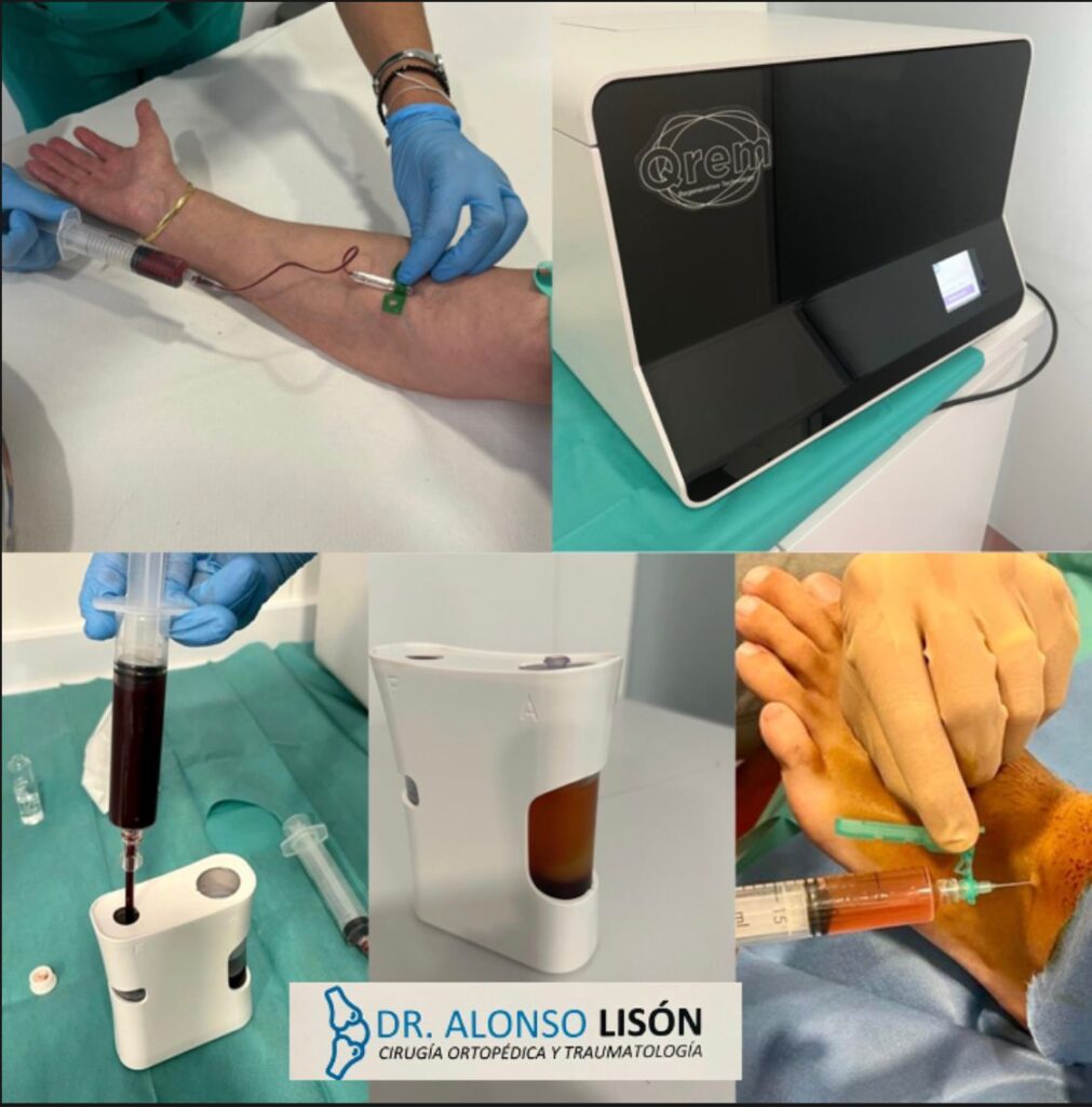 ¿Conoces el sistema Qrem-Cytokine? - Traumatólogo Murcia Doctor Alonso ...